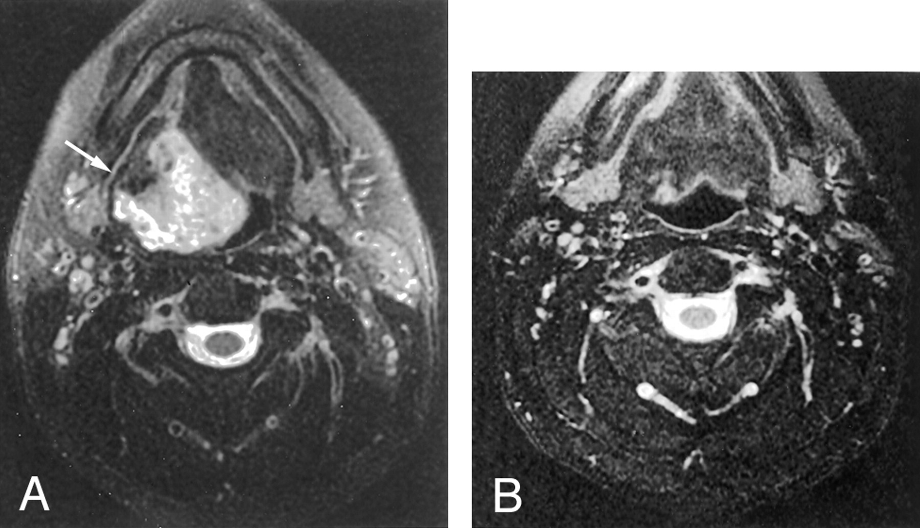 Percutaneous Ethanol Sclerotherapy Of Venous Malformations Of The