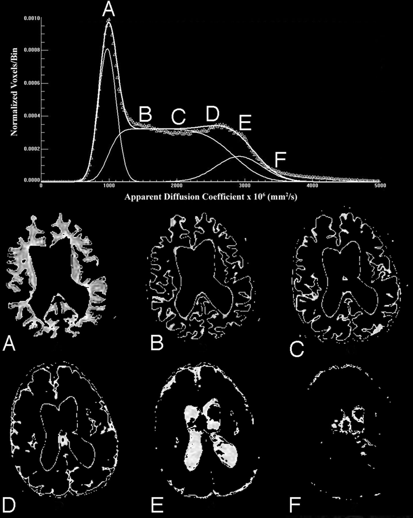 Assessing Disease Severity In Late Infantile Neuronal Ceroid