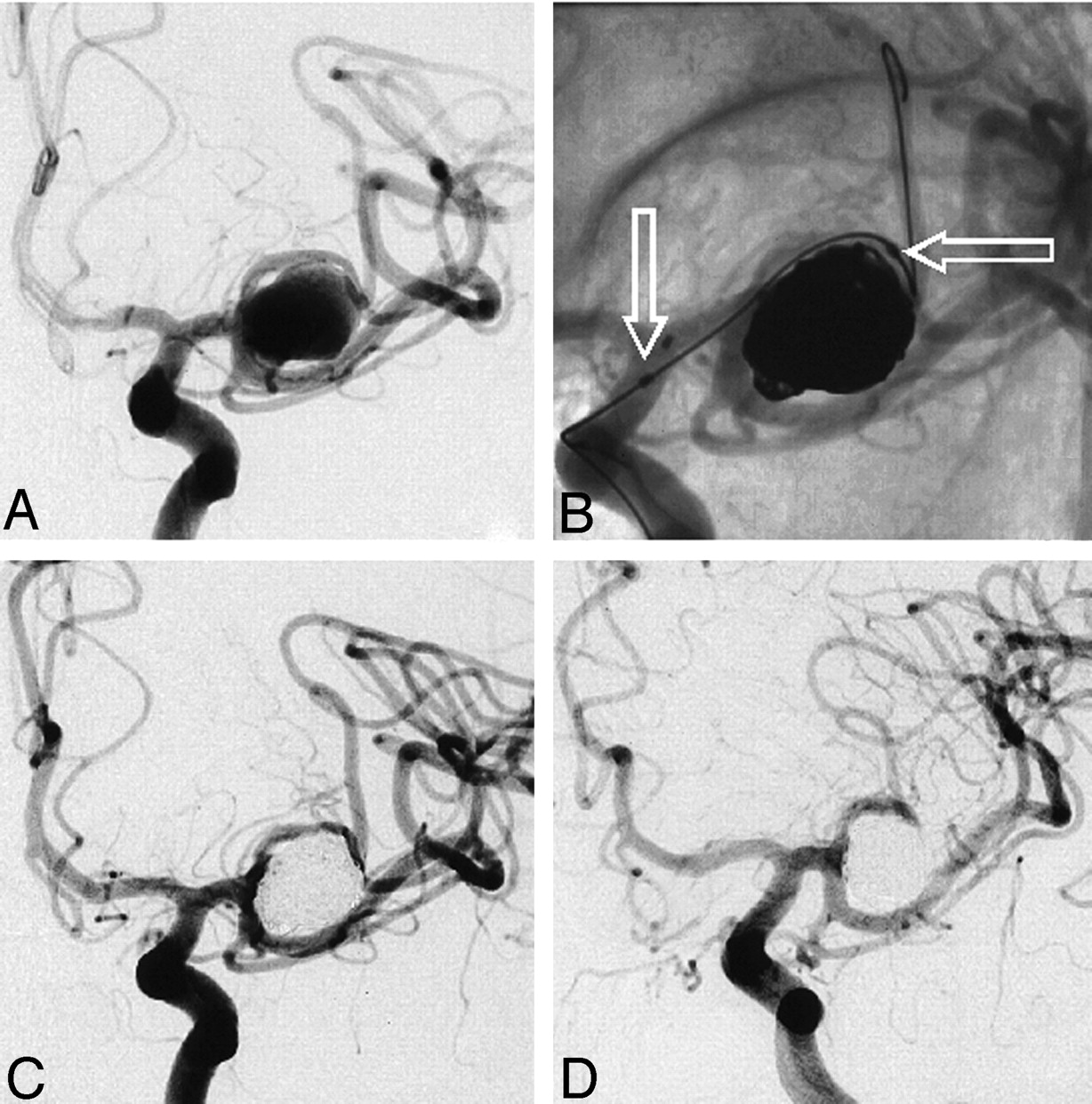 Cerebral Aneurysm Coiling